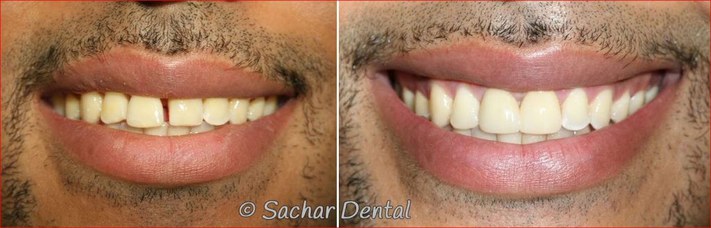 Cosmetic Dentist NYC | Sachar Dental NYC Before & After Pictures
