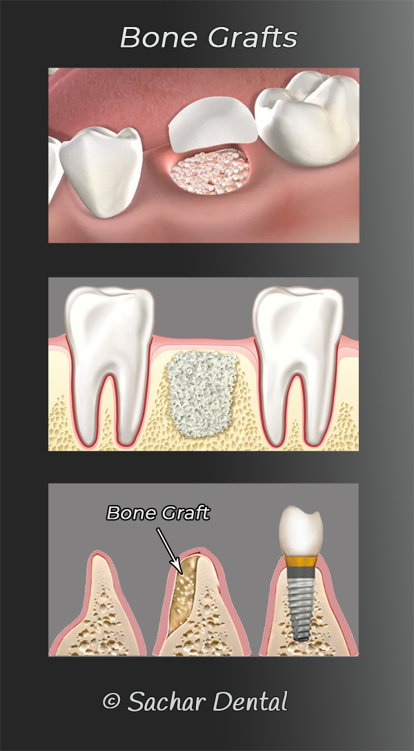 Bone Graft Membrane Smile Center