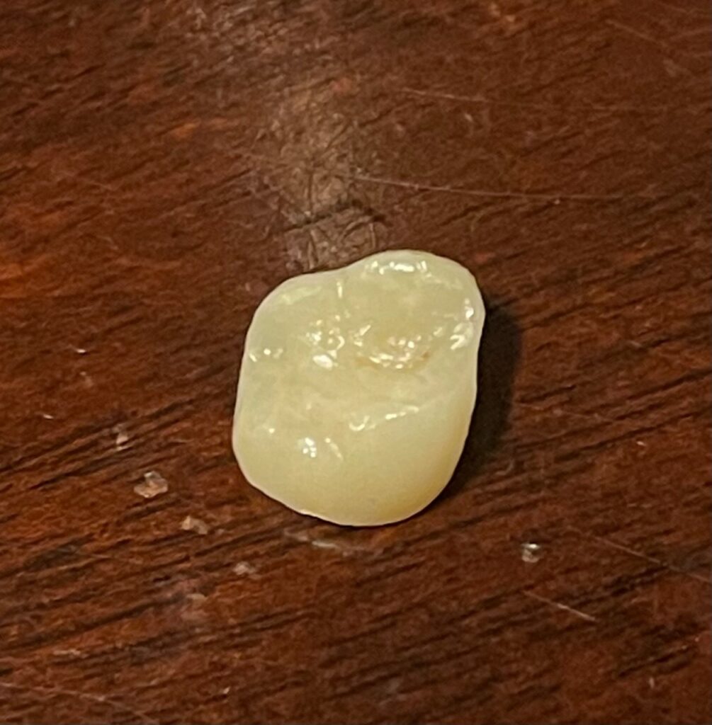 Emergency dentist for lost crown on holiday.