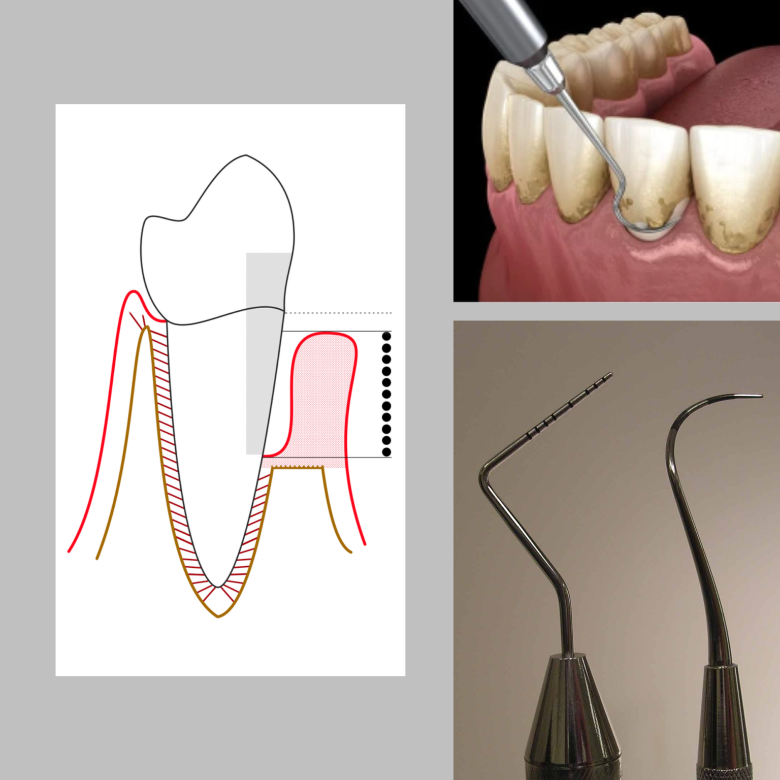 Periodontitis Treatment: Expert Care at Sachar Dental NYC