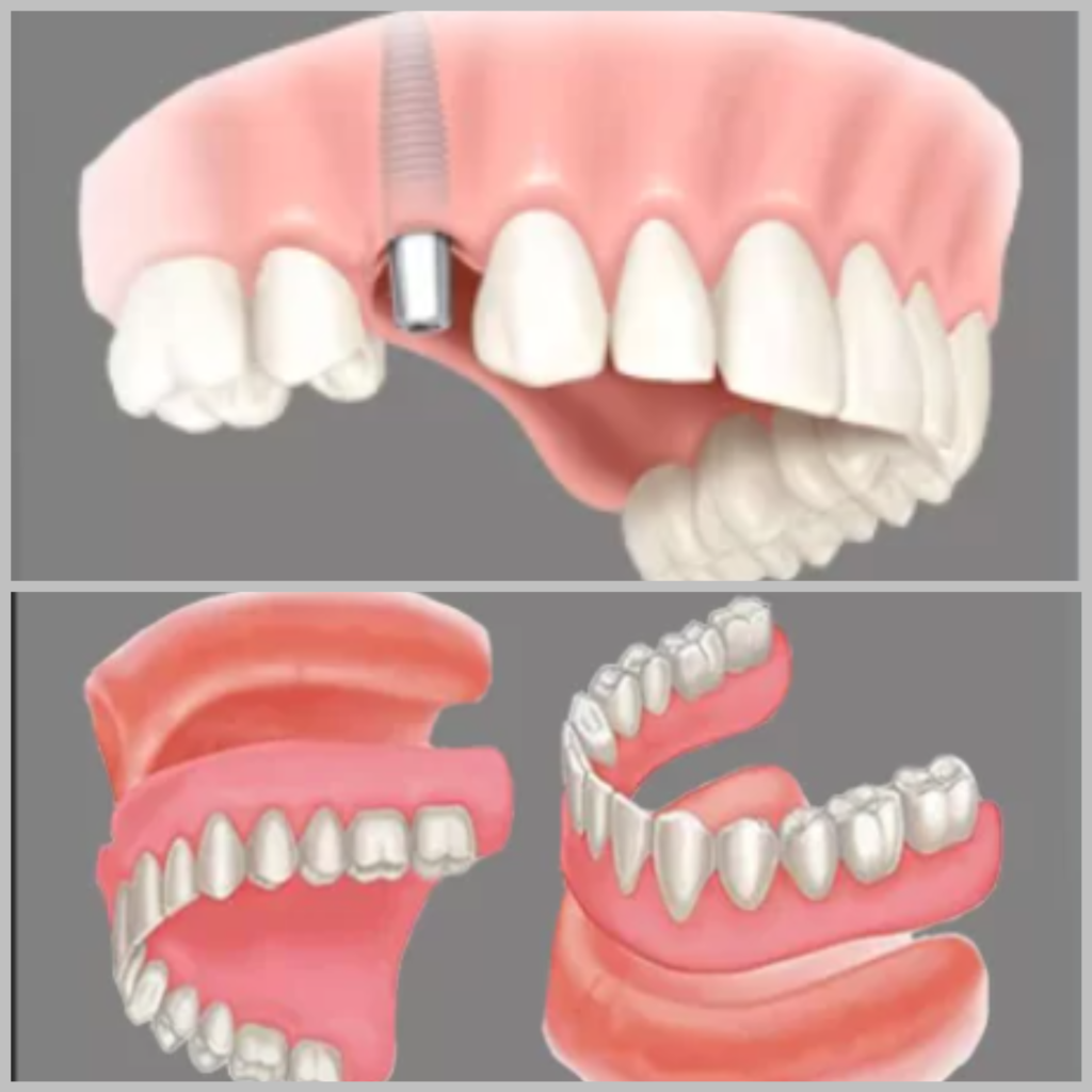 Best Dental Implants Guide