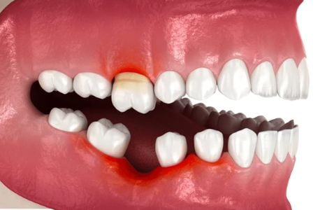 Missing Tooth Replacement NYC